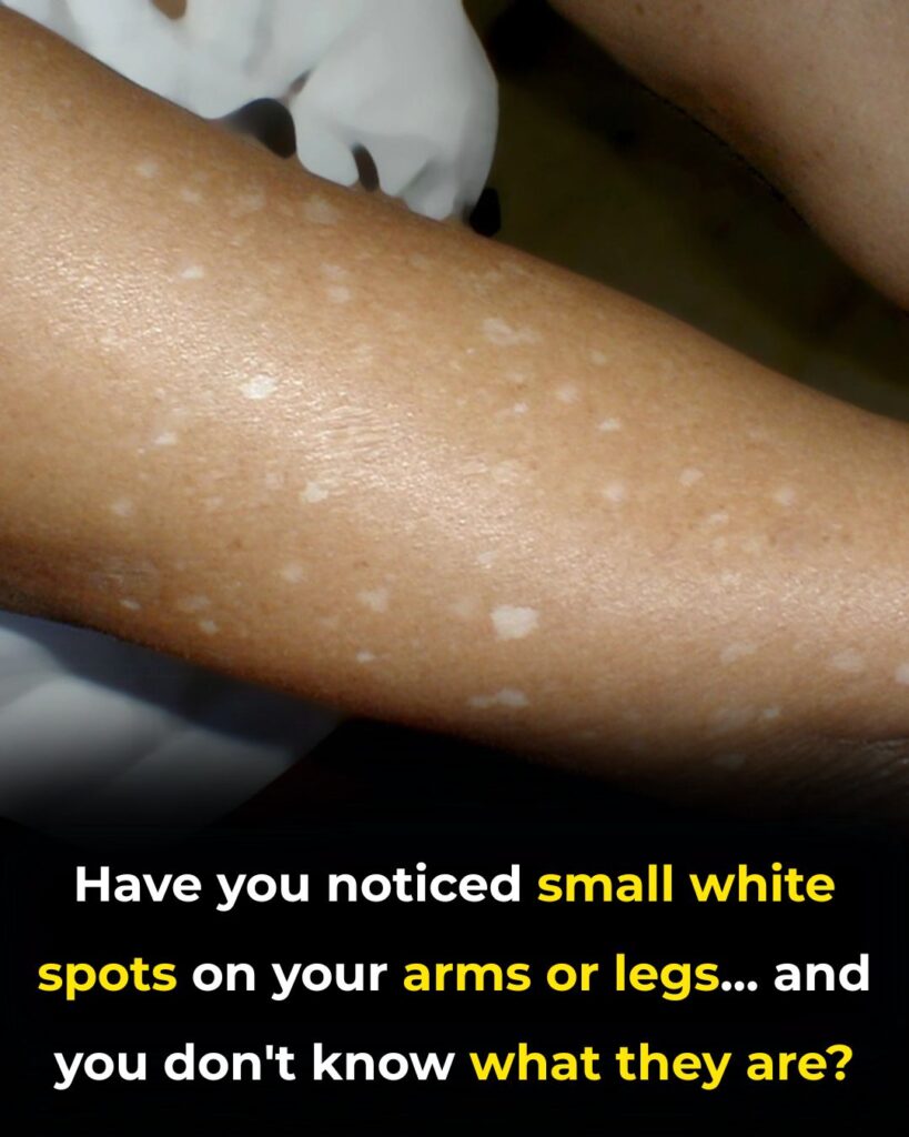 Have you noticed small white spots on your arms or legs… and you don't ...